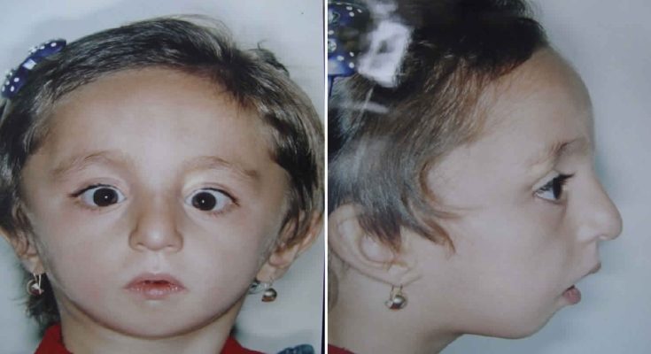 Nager Syndrome • Health blog